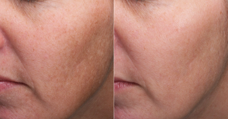 Moxi Laser Treatment in Boca Raton | Glamor Medical
