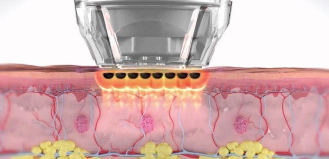 eMatrix Sublative Fractional Resurfacing Treatment | Glamor Medical