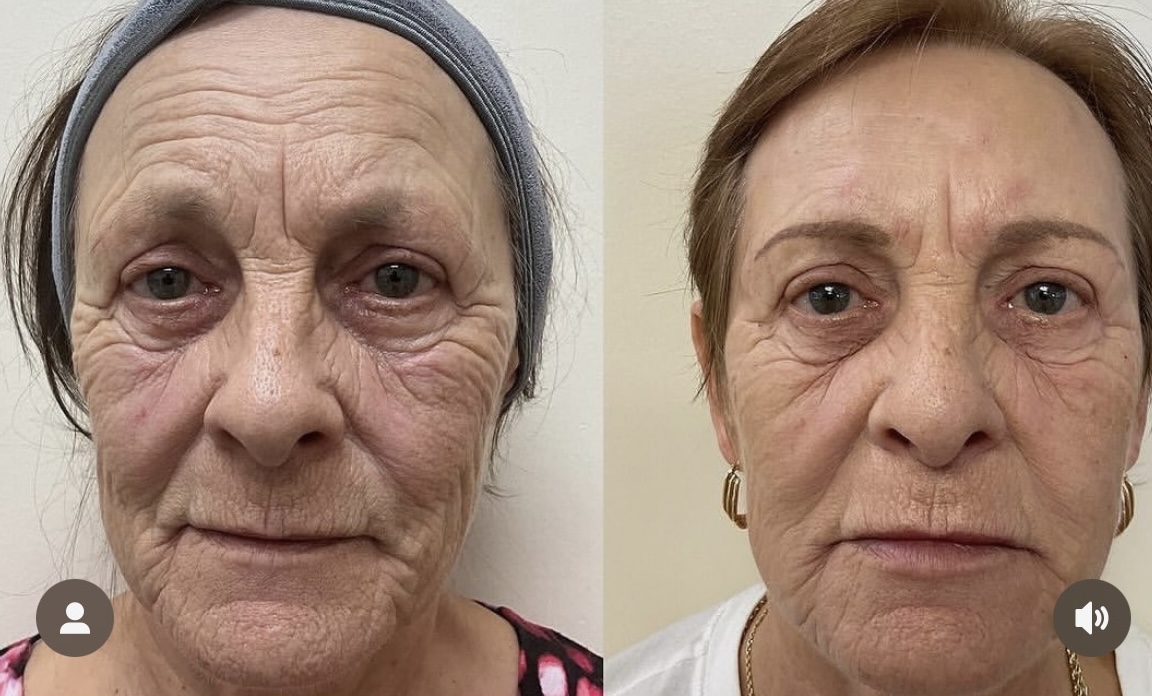 Helix Laser - Glamor Medical Boca Raton Boutique Spa