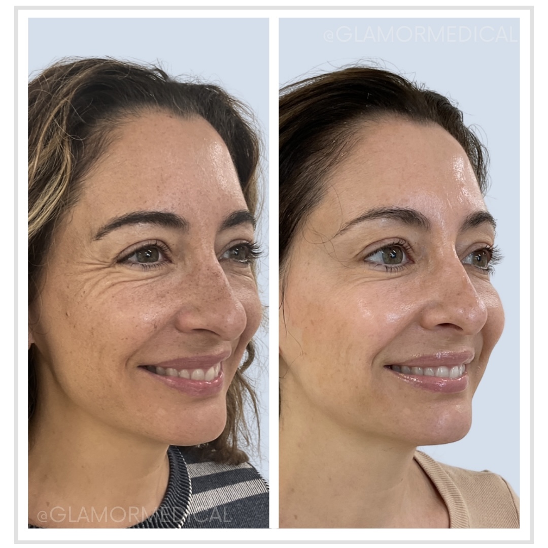 Staying Ahead in Modern Aesthetics - Glamor Medical Boca Raton Boutique Spa