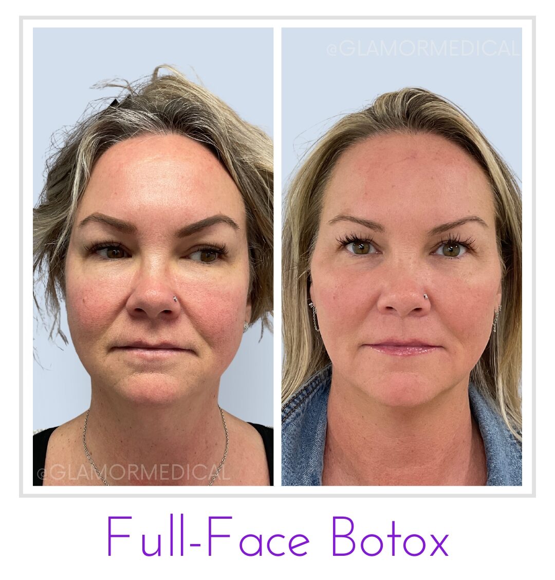 Full-Face Botox: Better, More Natural Results - Glamor Medical Boca ...