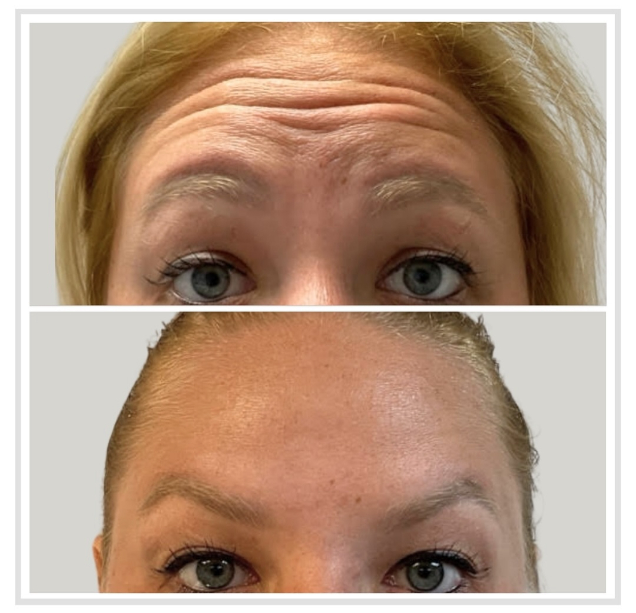 Preventative Botox in Boca Raton: When Is the Right Time to Start ...